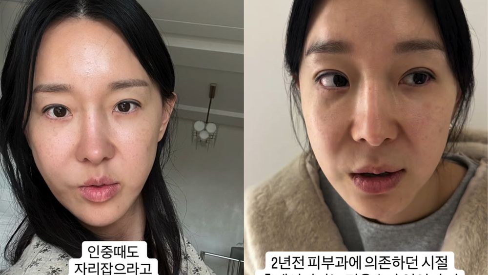 '인중 축소술' 이지혜, 수술 직후 공개…적나라한 모습